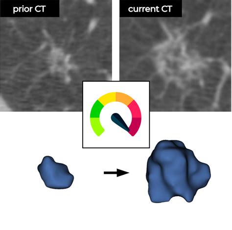 Deep Learning To Estimate Pulmonary Nodule Malignancy Risk Using A Current And A Prior Ct Image