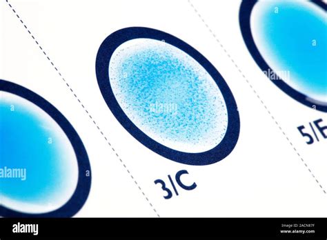 Streptococcus Grouping Test This Is The Streptocard Acid Latex Test
