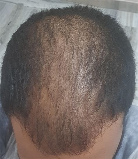 m24 indian facing mpb problem since 2yrs any suggestions will i be