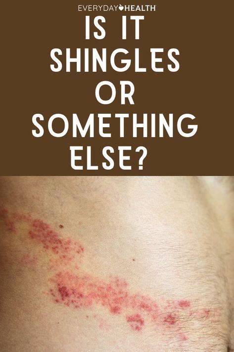 Learn The Difference Between The Shingles Rash And Other Common Skin