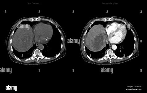 Ct Upper Abdomen Axial View Nc And A Phase Ddx Is Atypical Hcc Or Hepatocellular Carcinoma Stock