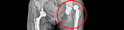 Revision Joint Surgery Birmingham Dr Herrick J Siegel