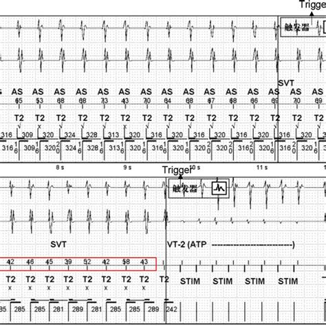 Episode Of Ventricular Tachycardia Vt Misdiagnosed As Download Scientific Diagram