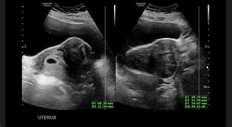 Miscarriage Or Subchorionic Hematoma 6 Weeks Pregnant R Pregnancy Care