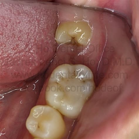 Operculectomy Dental Circumcision Ho Dental Office Dentist