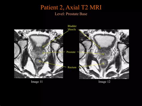 Prostate Mri Anatomy From University Of Michigan Ppt