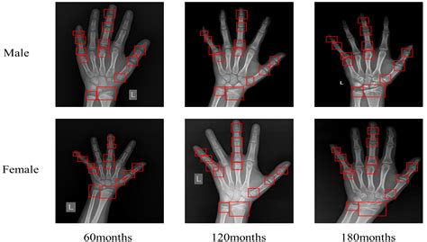 bones of the left hand and wrist