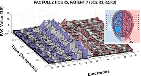 Figure 4 From Phase Amplitude Coupling Localizes Pathologic Brain With