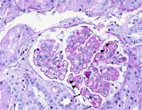 Sle Nephritis American Society Of Pediatric Nephrology Aspn