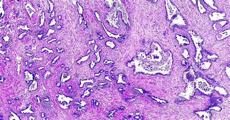 New Prostate Cancer Biomarkers To Help Improve Diagnosis And Treatment