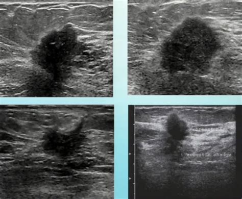 Практическое применение ультразвуковой шкалы Bi Rads в интервенционной маммологии Мифы и