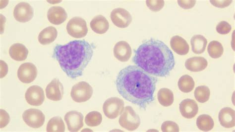 Hairy Cell Leukemia Symptoms Causes Treatments