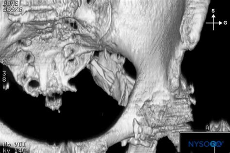 Sciatic Nerve Block Landmarks And Nerve Stimulator Technique Nysora Nysora
