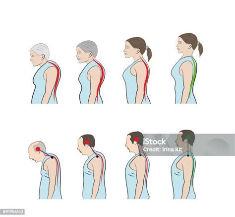 남성과 여성에서 척추의 증가 곡률을 보여주는 나이 굴복 하 질된 자세의 개발 벡터 일러스트 레이 션 노화에 대한 스톡 벡터 아트 및 기타 이미지 Istock