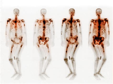 Bone Scan Showing Multiple Metastases Photograph By Scott Camazine