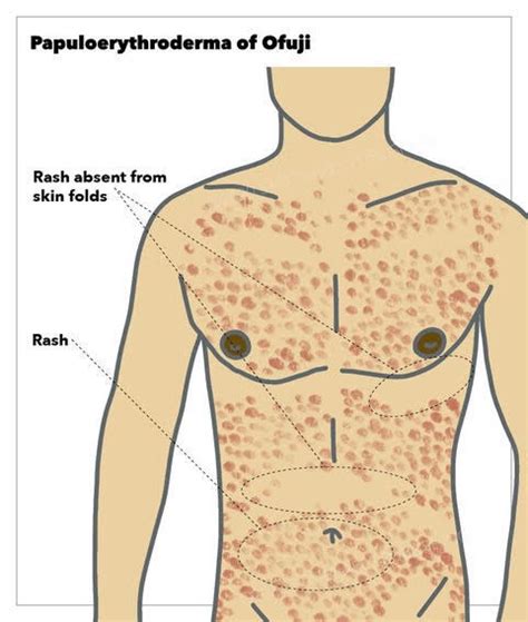 Figure Papuloerythroderma Of Ofuji Rash Skin Folds Statpearls Publishing Illustration