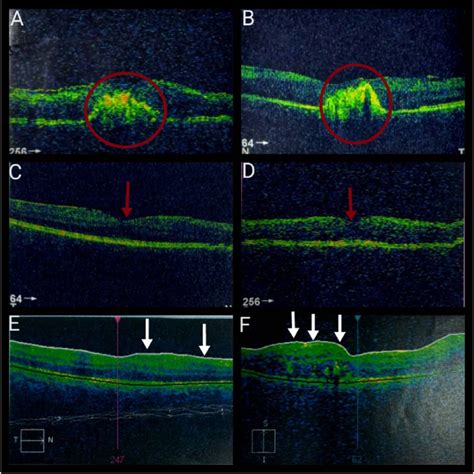 A B C D E F A B Left Eye Macula Oct Macular Scar Red Download Scientific Diagram