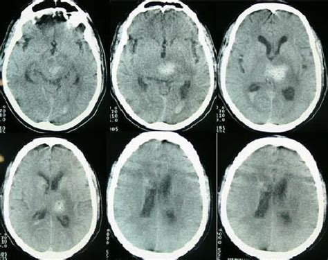 Post Operative Ct Scan Post Operative Ct Scan Of The Patient Depicted