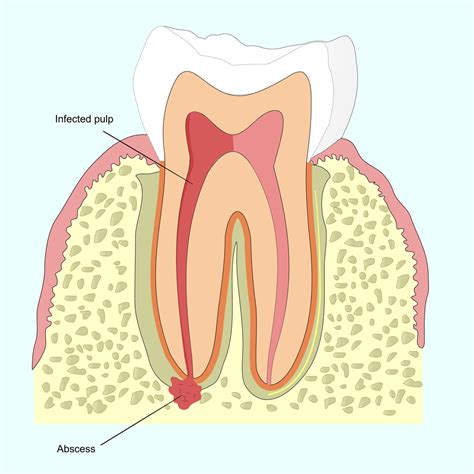 Root Canal Recovery Montreal Qc Drs Charles And Patrick Casey