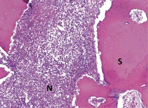 Histo Path SDL 3 Osteomyelitis Flashcards Quizlet
