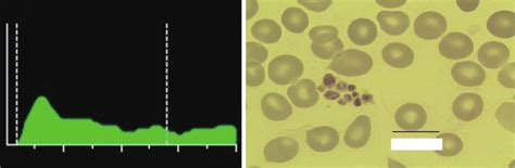 Typical Platelet Histogram And Microscopic Pictures Of Edta Ptcp Download Scientific Diagram