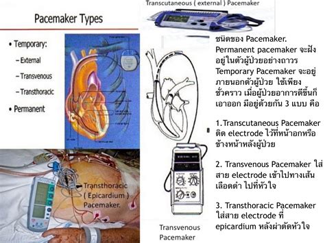 Chapter 8 Pacemaker 2018 Book Final ไกรศร จันทร์นฤมิตร หน้าหนังสือ
