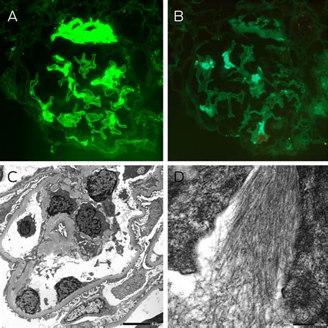 Systemic Amyloidosis In A Patient Presenting With Myopathy Peripheral Oedema And Proteinuria