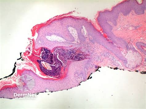 Elastosis Perforans Serpiginosa Pathology