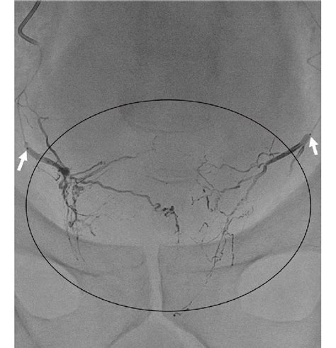 Pelvic Ap View After Embolization Legend In The Black Circle Download Scientific Diagram