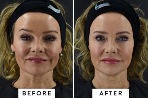 Collagen Induction Therapy RF Lifespan Euro Med Spa