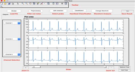 Projects2015s2 210 Automated Classification Of Heartbeats In Long Term