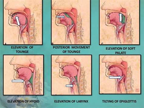 Dysphagia