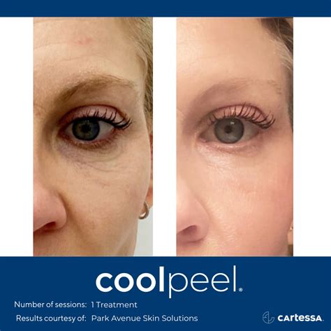 Coolpeel™ Treatment Before And After Gallery