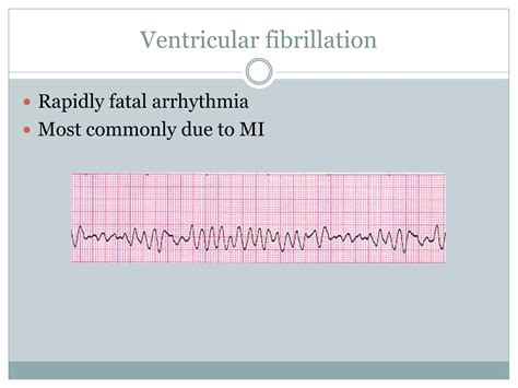 Interpretation Of Common Ecg Abnormalities PPTX