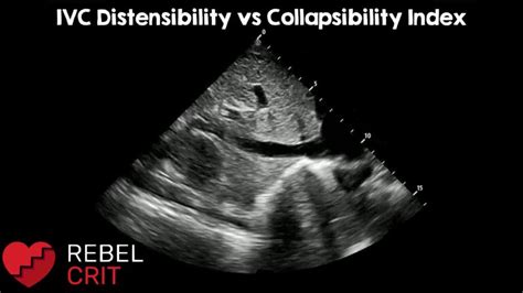 Ivc Distensibility Index Vs Collapsibility Index Using The Correct Index Rebel Em Emergency