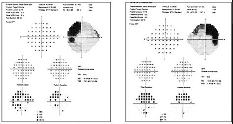 Seven Common Errors In Glaucoma Management And How To Avoid Them Insight