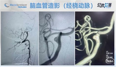 支架辅助弹簧圈栓塞左侧椎动脉v4段动脉瘤