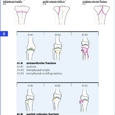 A B Proximal Tibial Aoota Classification Download Scientific Diagram