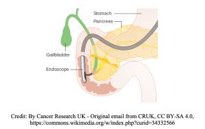 Complications Of ERCP ED Presentations Evaluation And Management EmDocs
