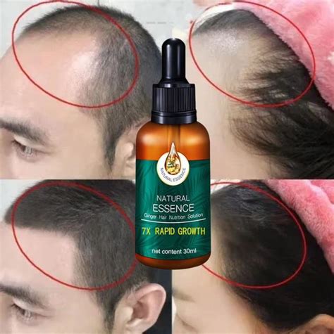 Ginger King Serum Anti Botak Rambut Lebat Sehat Berkilau Penumbuh Rambut Secara Cepat Penyubur