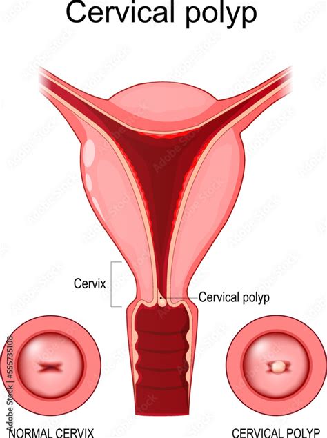 Cervical Polyp Normal Cervix And Benign Tumor On The Surface Of The Cervical Canal Stock