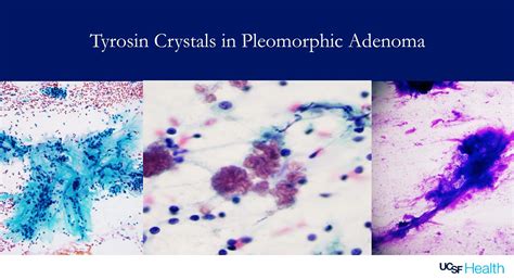 Tyrosine Crystals Pleomorphic Adenoma