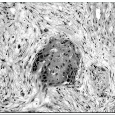 B A High Power 20 X Objectives Of A Focus Of An Invasive Squamous