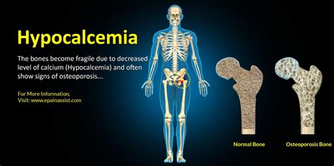Calcium Deficiency Disease Hypocalcemia Causes Symptoms Diagnosis Hot