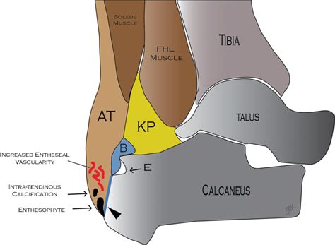 Achilles Enthesophyte Definition At John Layh Blog