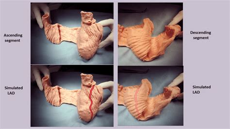 Anatomy Modification With Simulated Left Anterior Descending Artery