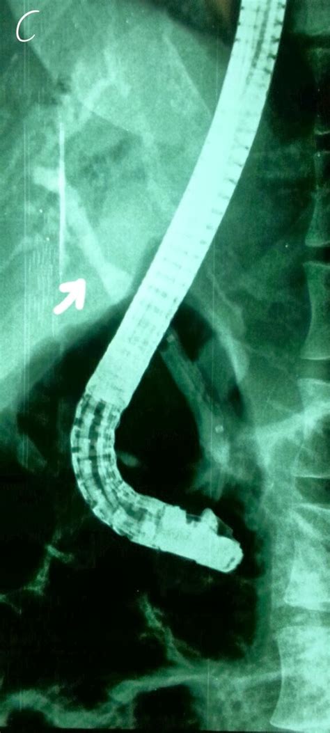 ERCP EGD Fourth Follow Up ERCP For A Post Cholecystectomy CBD Stricture