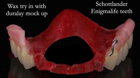 Finlays Newsletter 60 Sylvias Upper Kennedy Class 2 Mod 1 Metal Based Upper Rpd Finlay Finlays Newsletter 60 Sylvias Upper Kennedy Class 2 Mod 1 Metal Based Upper Rpd Finlay