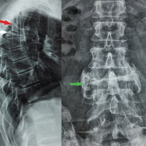 Thoracolumbar Spine Radiography Showed Thoracic Spine Deformation With