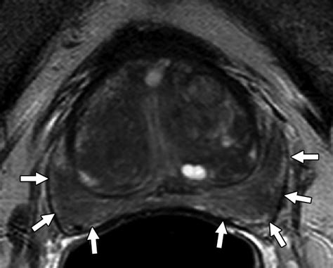 Multiparametric Mri Of The Prostate Youtube